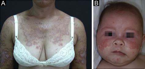 Cutaneous Lupus Face