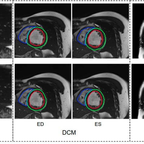 Visualization Of Good Segmentation Examples Selected From Three Patient Visualization Of Good Segmentation Examples Selected From Three Patient
