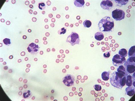 Cytology Of Peritoneal Fluid A Few Active Neutrophils Several