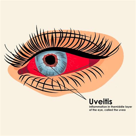 Uveitis Symptoms Causes Treatment And Types Vedic Med Global