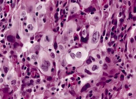 25 Facts About The Centrocyte Small Cleaved Cell