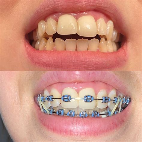 7 Months Progress Open Bite And Overcrowding R Braces