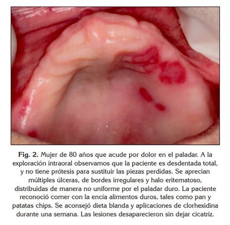 Pdf Lesiones Traumáticas En La Mucosa Oral De Los Adultos Mayores