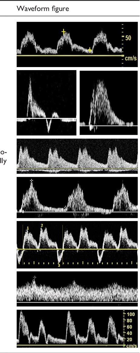 [pdf] Interpretation Of Peripheral Arterial And Venous Doppler Waveforms A Consensus Statement