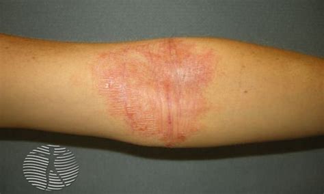 Eczema On Elbow Crease Eczema On Arms And Elbows Managing Symptoms