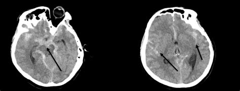 Computed Tomography Of The Head Showing Large Subarachnoid Hemorrhage Download Scientific