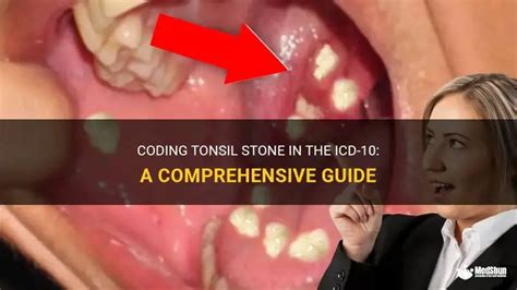 Coding Tonsil Stone In The Icd 10 A Comprehensive Guide Medshun