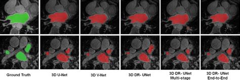 Examples Of La Segmentations Generated Using Each Network For The Lasc