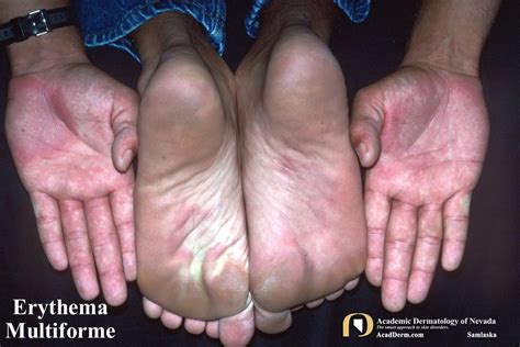 Erythema Multiforme Erythema Exudativum Multiforme Academic