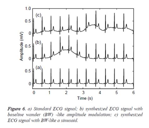 Detecting And Classifying Ecg Abnormalities Using A Multi Model Methods