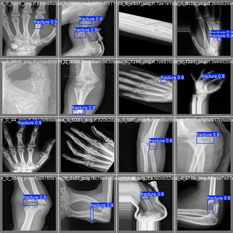 Bone Fracture Detection V1i Yolov8 Kaggle