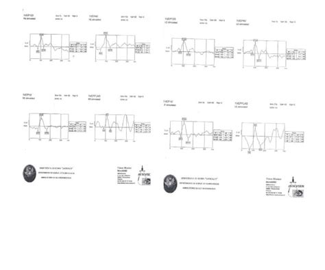 The Visual Evoked Potentials VEP Revealed A Decrease In VEP Amplitude Download Scientific