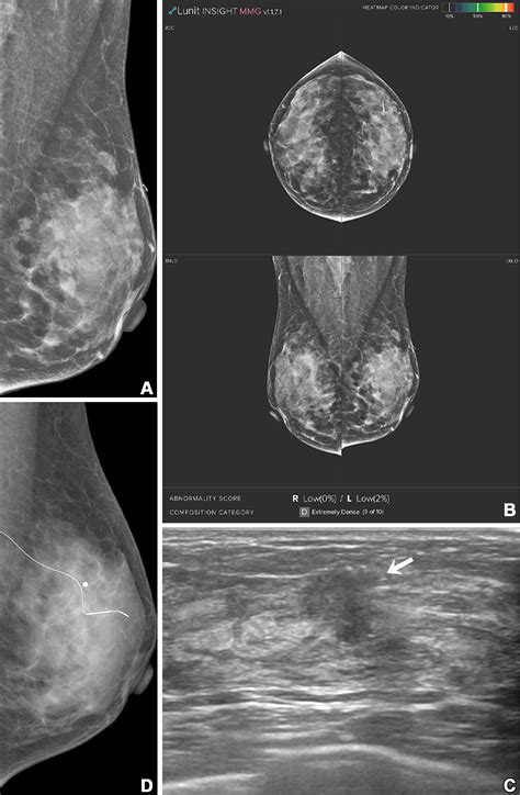 Screening Outcomes Of Mammography With Ai In Dense Breasts A