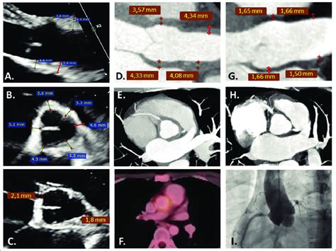 Multimodality Imaging Assessment At Baseline And Follow Up A B Download Scientific Diagram