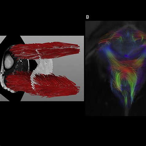 Diffusion Tensor Imaging Based Fiber Reconstructions Of The Human