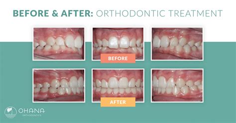Overbite Correction With Retainers