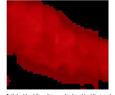 Figure 1 From Clutter Suppression Algorithm Of Ultrasonic Color Doppler Imaging Based On Bp