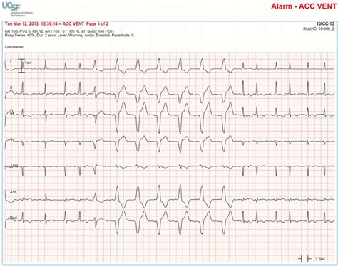 false accelerated ventricular rhythm alarm in a patient with