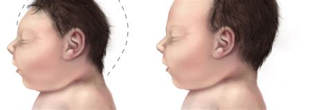 Cdc Confirms Zika Causes Microcephaly Birth Defect May Be “tip Of The Iceberg” Ars Technica