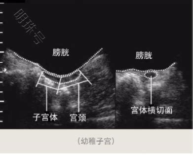 幼稚子宫能够生育吗只要不放弃总会有希望 女性疾病频道 东方养生
