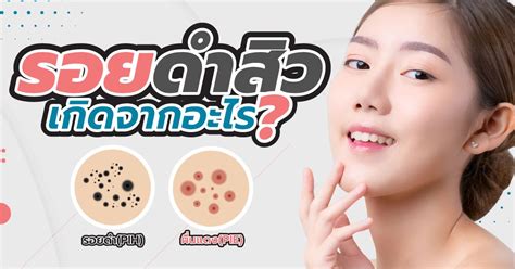 Pico Laser รอยดำสิว หน้าใสไร้รอยดำ Th