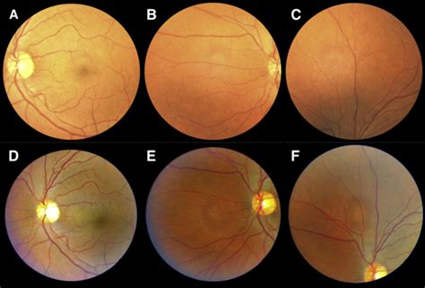 Sensitivity And Specificity Of Smartphone Based Retinal Imaging For