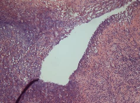 Lung Abscess Etiology Diagnostic And Treatment Options Pmc