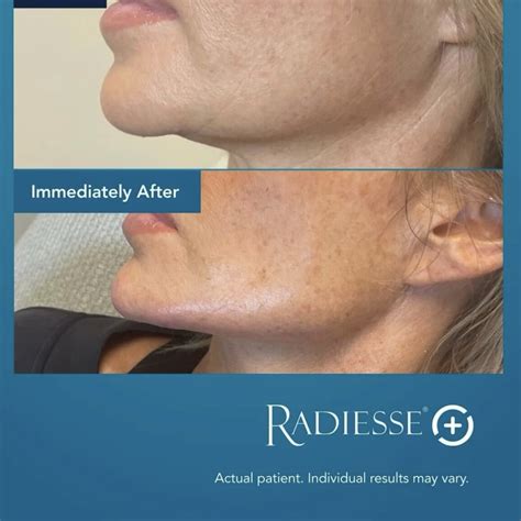 Radiesse Dermal Filler Wrinkle Treatment Wellington Fl