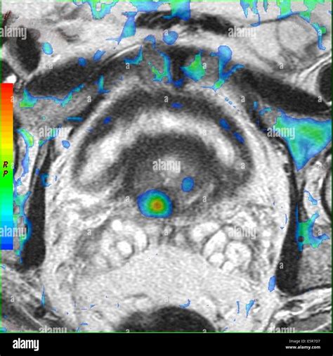 Colored Mri Magnetic Resonance Imaging Showing A Prostate Cancer Seen