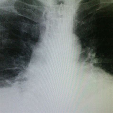 Control Native Lung Rtg On One Day After Surgery Download Scientific