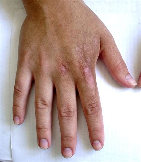 The Many Faces Of Phytophotodermatitis