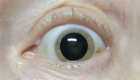 Using Atropine For Cycloplegic Refraction May Avoid Overestimation Of