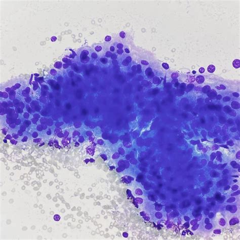 Thyroid Fna ~50yo F Rcytopathology