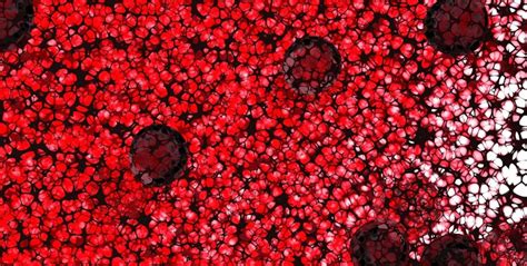 Thrombus Burden Greater In Stemi Patients With Covid 19