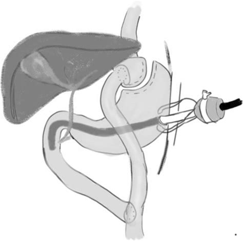 Laparoscopy Assisted Endoscopic Retrograde Cholangiopancreatography Download Scientific Diagram