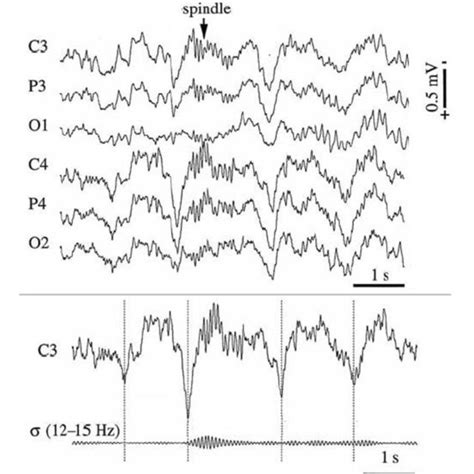 Intracranial Eeg Electrodes A Strip Electrode Targeting The