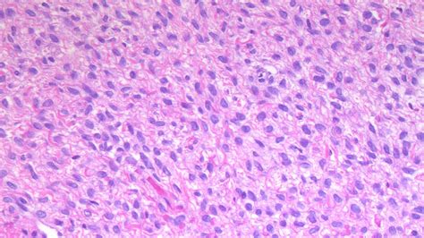 Thecal Cells Archives Ottawa Atlas Of Pathology