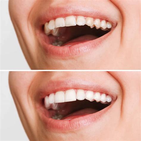 Porcelain Crowns Vs Veneers