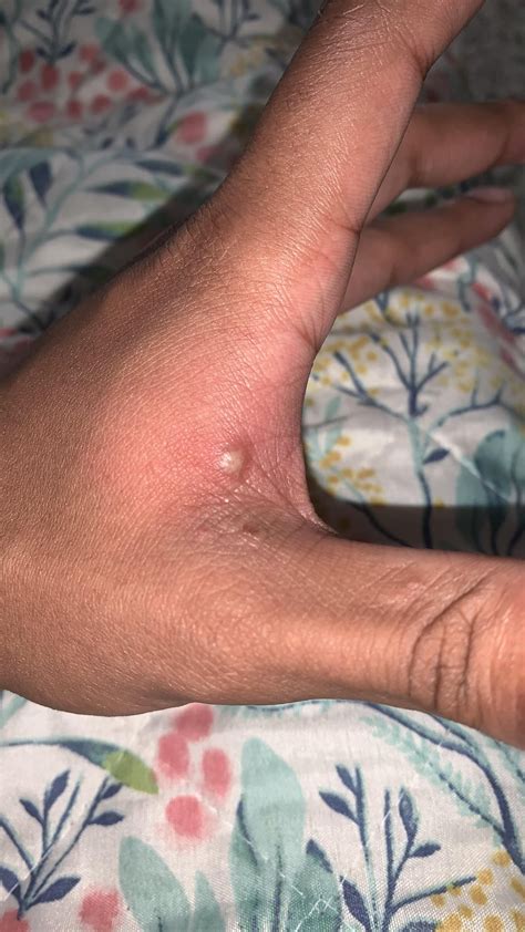 Weird Inconsistent Rash On Hands What Is It And How To Get Rid Of It