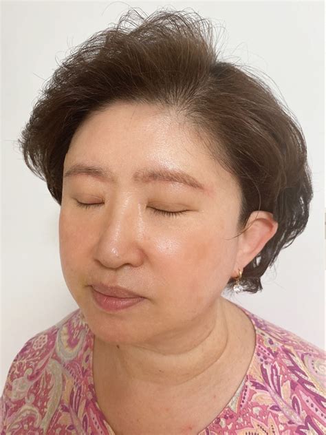 상안검수술 5개월차 중년 쌍꺼풀수술 비용 회복기간 후기 모든 것 네이버 블로그