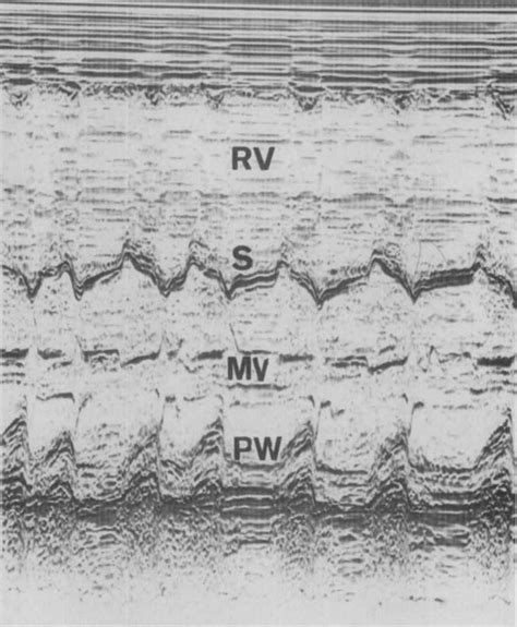M Mode Tracing Obtained From Apatient Having Bilateral Endomyocardial