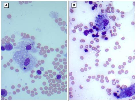 Aspirate Sample Showing Histiocytes Not Engulfing Intact Cells Download Scientific Diagram