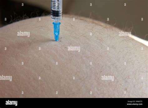 Needle Injecting Into The Muscle Nurse Doing A Trigger Point Injection