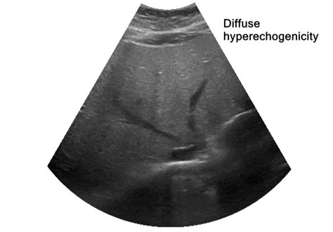 Hepatic Steatosis Fatty Liver Sonographic Tendencies