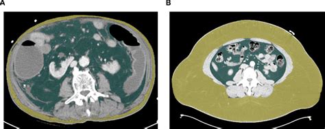 Assessment Of Visceral And Subcutaneous Adipose Tissue Distribution Download Scientific