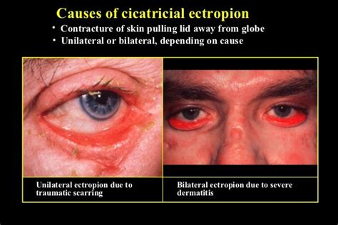 Ectropion And Entropion