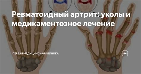 Ревматоидный артрит уколы и медикаментозное лечение Первая Медицинская Клиника Дзен