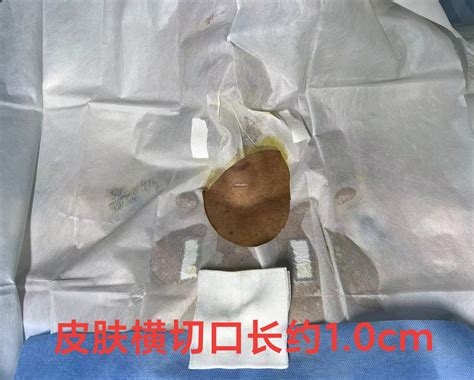 床旁纤支镜引导下经皮气管切开 脑医汇 神外资讯 神介资讯