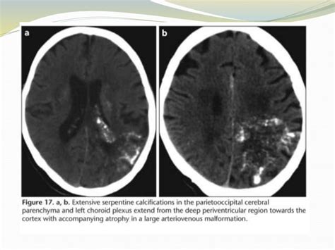 Physiological And Pathological Calcification Of Brain Pptx