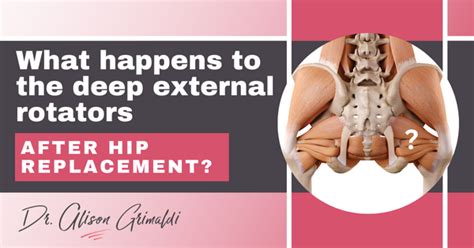 What Happens To The Deep External Rotators After Hip Replacement Find Out More